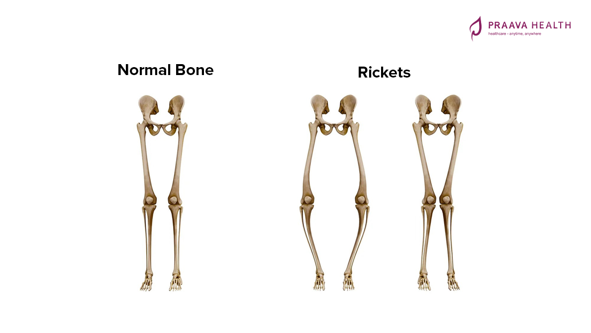 How Rickets Affects Your Child's Growth: Symptoms and Treatments ...